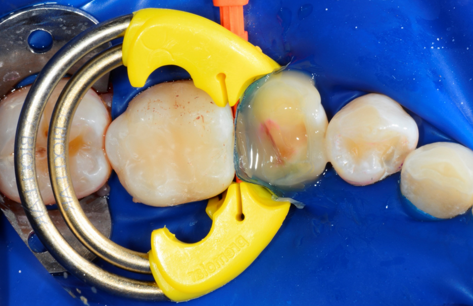 How Bioclear Challenges Age-Old Thinking About Treatment Of Caries - Optident